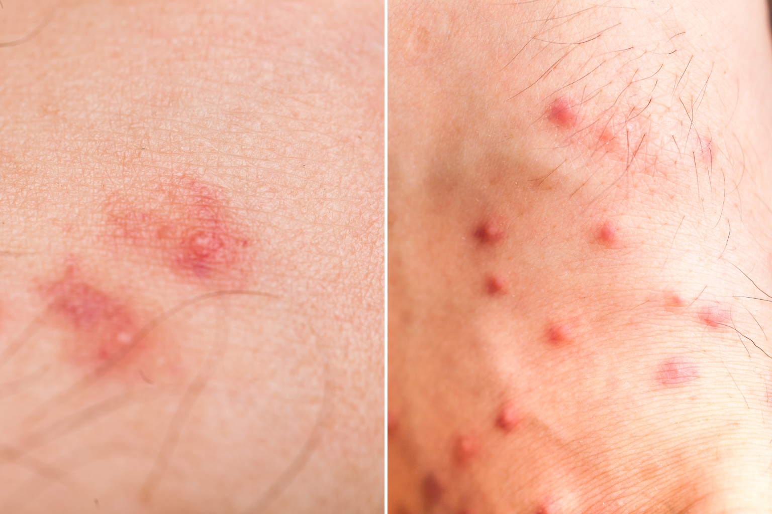 What Do Flea Bites Look Like On Humans? [With Pictures!]